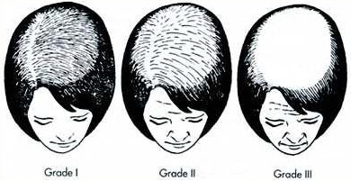 Ludwig Classification - Seager Hair Transplant Centre Toronto