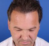 Hair Transplant Photo Gallery | Hair Restoration Before & After Photos ...